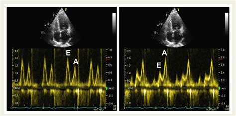 Valsalva Maneuver In A Patient With Grade Ii Diastolic Dysfunction At Download Scientific