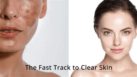 Pico Laser Before And After Treatment Rheinlaser