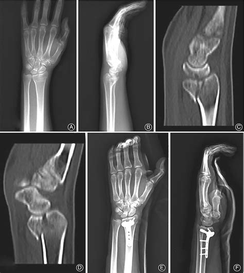 Die Punch Fracture Classification At Sabrina Swensen Blog