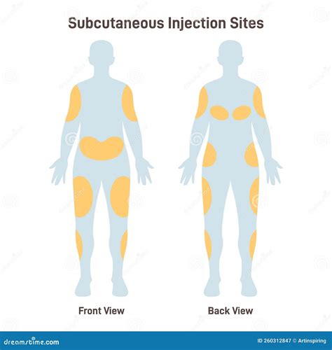 Sites D injection Sous cutanée Sites D injection De Médicaments Sur Le