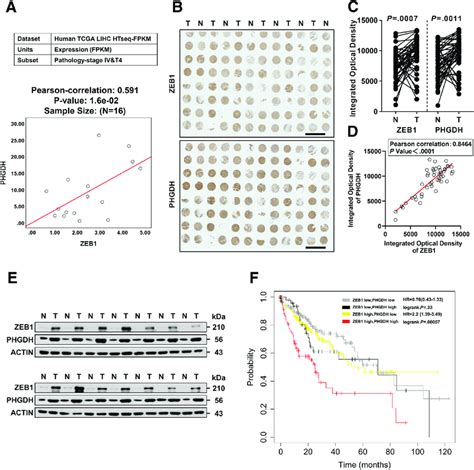 Interrelated High Expression Of ZEB1 And PHGDH Is Correlated With Poor