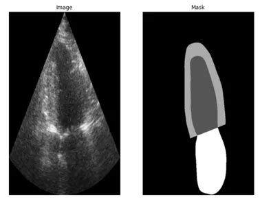 Preprocessing The Image Dataset For Left Ventricle Segmentation Datadance