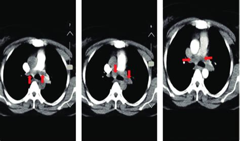 Submissive Emboli In The Pulmonary Artery Extended To Left And Right