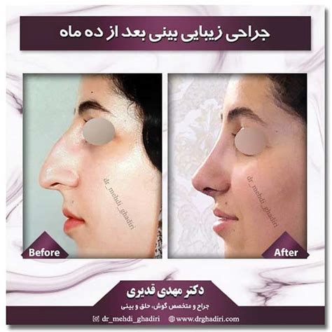 جراحی زیبایی بینی دکتر مهدی قدیری