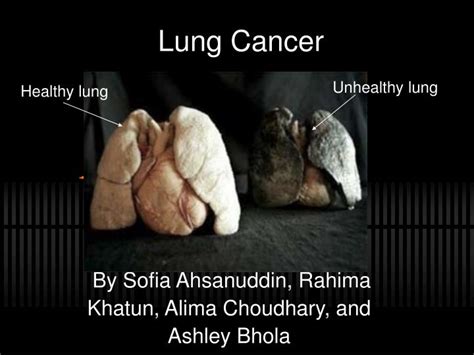 Ppt Lung Cancer Powerpoint Presentation Free Download Id5526958