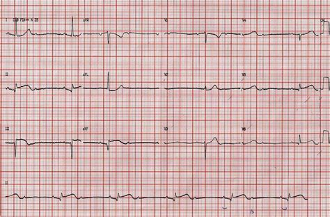 Blog de Eletrocardiografia EVOLUÇÃO CLÍNICA DO INFARTO AGUDO DO