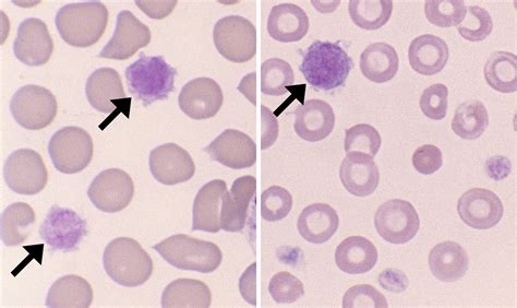 Giant Platelet Cells And Smears