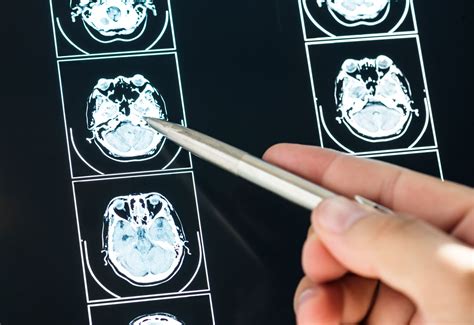 Acidente Vascular Cerebral AVC NEUROCLÍNICA SIMIS