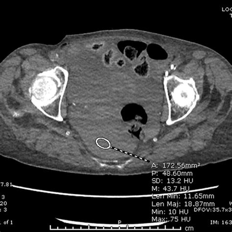 Noncontrast Computed Tomography Of Abdomen Download Scientific Diagram