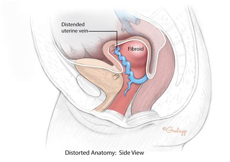 View Chriss Medical Illustrations For Medical Legal Cases — Chris