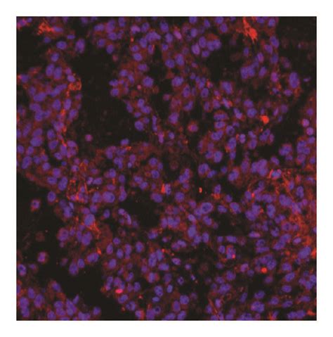 Immunofluorescent Staining Of The Fibrin Expression In The Tumor