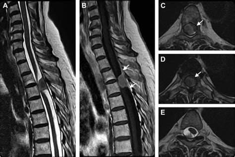 Intradural Extramedullary Tumors And Associated Syndromes Neuroimaging Clinics