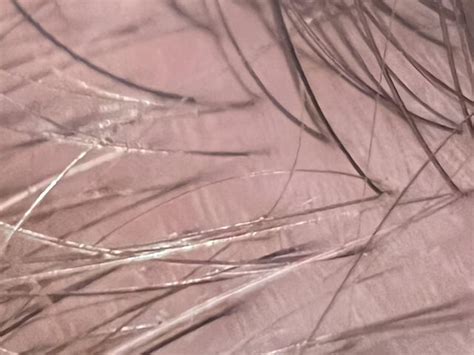 Silver Scalp Scale R Dermatologyquestions