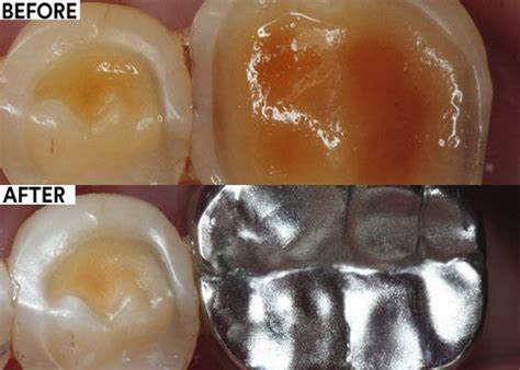Dan Durenberger On Linkedin Clinical Case Selective Etch Adhesive