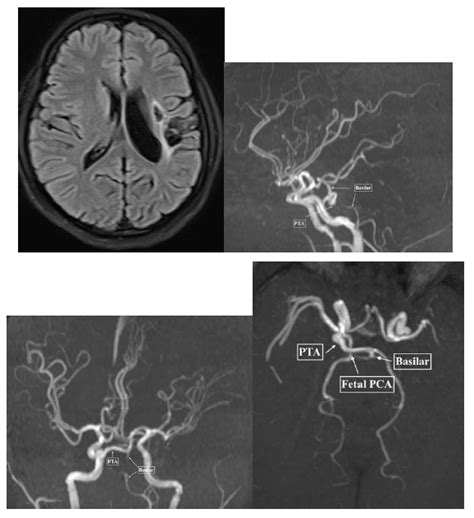 Stroke In Setting Of Persistent Trigeminal Artery Report Of Two Cases