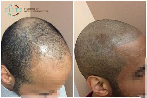 Scalp Micropigmentation Atlanta Ga Elite Institute Of Micropigmentation