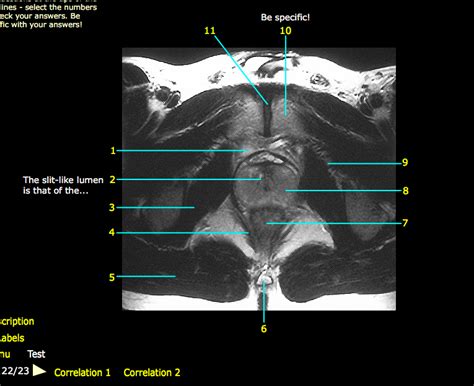 Prostate Gland Anatomy Mri