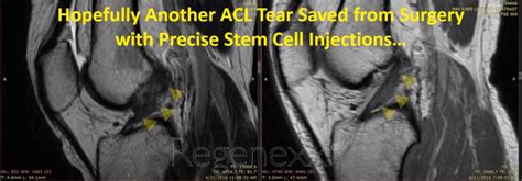 Acl Mri Evidence For The Perc Aclr Centeno Schultz Clinic