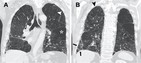 Dark Field Chest Radiography Of Combined Pulmonary Fibrosis And