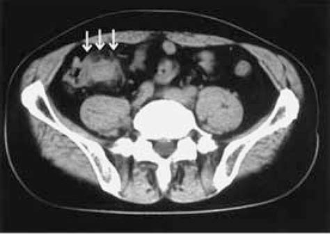 [pdf] A Case Of Mesenteric Abscess Around The Ascending Colon Due To