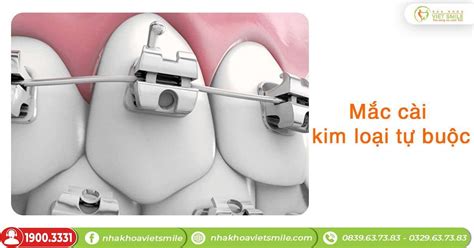 Niềng Răng Mắc Cài Kim Loại Tự Buộc Là Gì