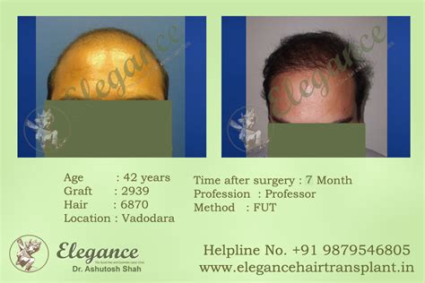 Follicular Unit Transplantation