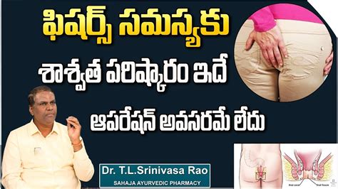 Anal Fissure Causes Precautions And Treatment By Drtlsrinivasa Rao