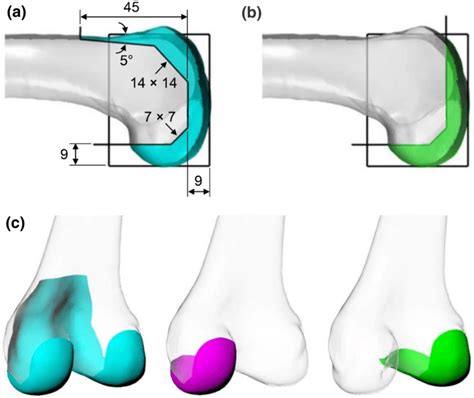A The Schematic Of Tka Femur Cutting B The Schematic Of Lm Uka