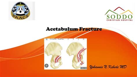 Acetabulum Fracture Treatment And Classification Pptx