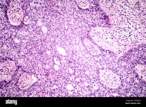 Photomicrograph Of Basal Cell Carcinoma Displaying Malignant Basal