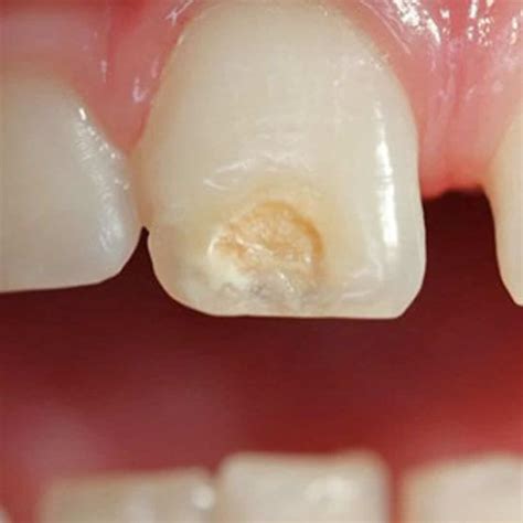 Manchas Marrones En Los Dientes ¿qué Hacer Doncomo ️