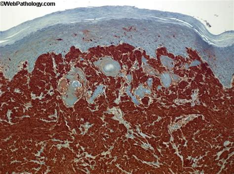 Granular Cell Tumor In Scrotum