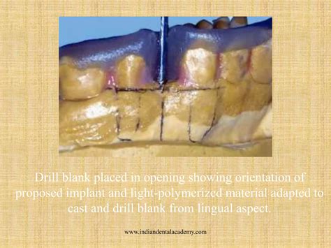 Surgical Implant Placement Guides Dentistry Dental Implants Ppt