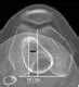 The Tibial Tuberosity Trochlear Groove Distance A Comparative Study