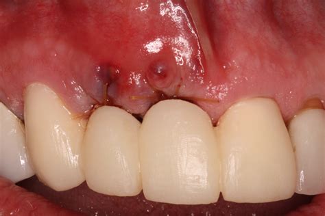 Front View Bone Graft And Dental Implants Ryan Lanman Dds Msd