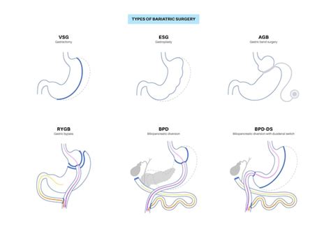 Tipos De Cirurgia Bariátrica Estômago E órgãos Internos Saudáveis Após