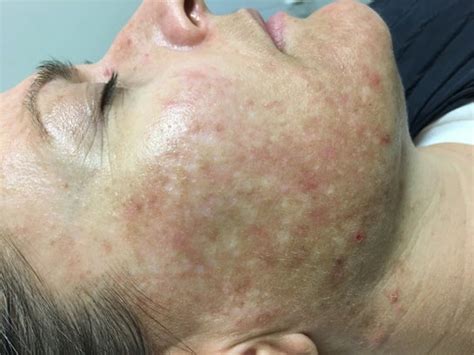 Hypopigmentation Face