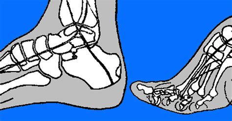 The Effects Of Foot Binding On The Foot Bones World History Encyclopedia
