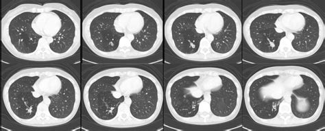 Intralobar Pulmonary Sequestration Presenting As Multiple Nodular