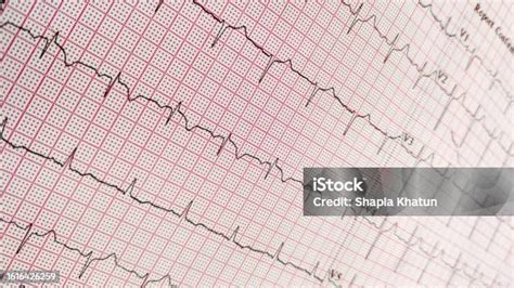 Ecg Ecg Électrocardiogramme Montrent Le Modèle De Bradycardie Sinusale