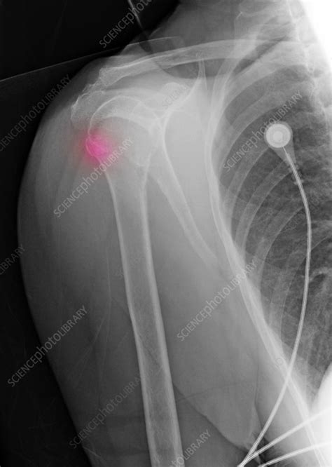 Upper Humerus Fracture Osteoporosis Stock Image C0305881