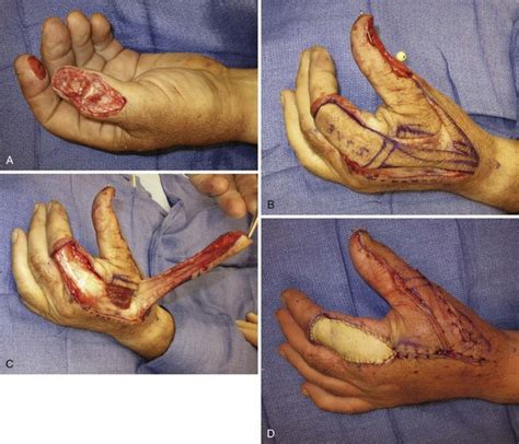 Soft Tissue Coverage For Extensor Tendon Reconstruction Plastic