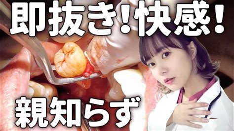 閲覧注意親知らずの抜歯全部お見せします抜歯中抜歯後のポイントも YouTube