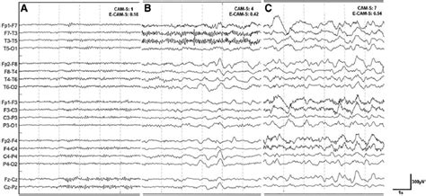 electroencephalography eeg patterns vs delirium severity examples download scientific