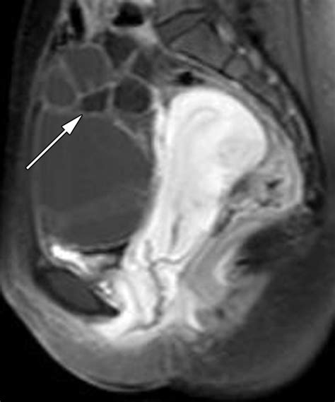 Mucinous Neoplasms Of The Ovary Radiologic Pathologic Correlation Pmc