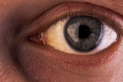 Yellow Eyes Jaundice