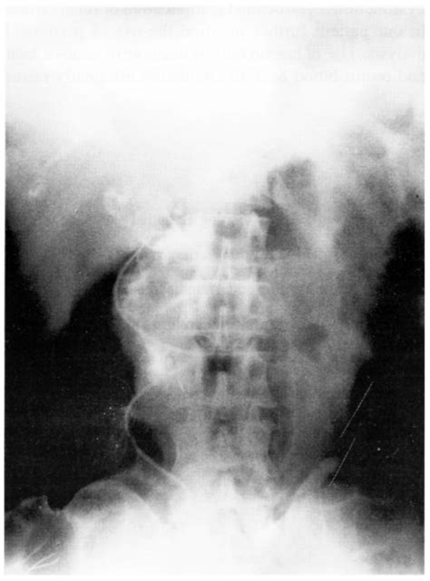 Per Operative Cholangiogram Showing Absence Of Gall Bladder Download