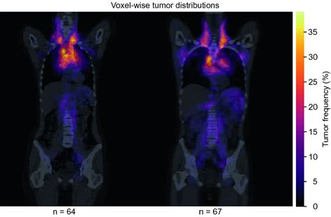Metabolic Tumor Volume Distributions Derived From Between Subject Download Scientific Diagram