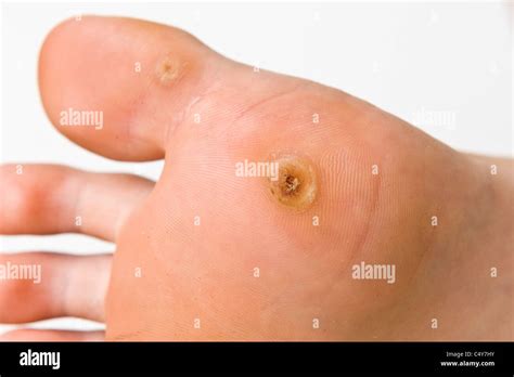 Wart Foot Hi Res Stock Photography And Images Alamy