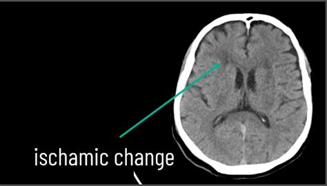 Hypodense And Hyperdense In Ct Ct Scan And Mri